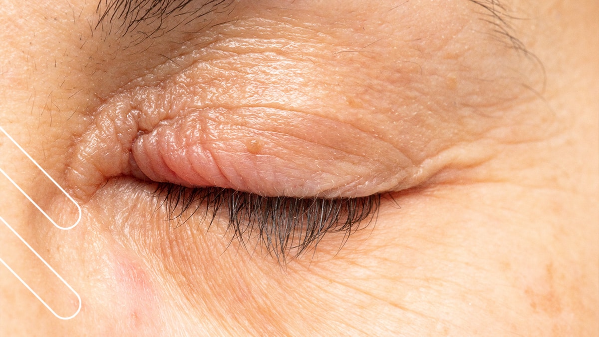 Blefaroplastia cosmética | Centro oftalmológico ICQO