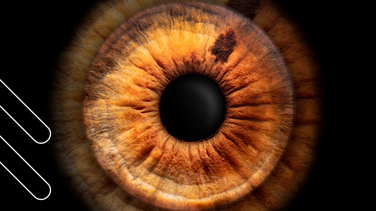 Colobomas - ICQO | Instituto Clínico Quirúrgico de Oftalmología