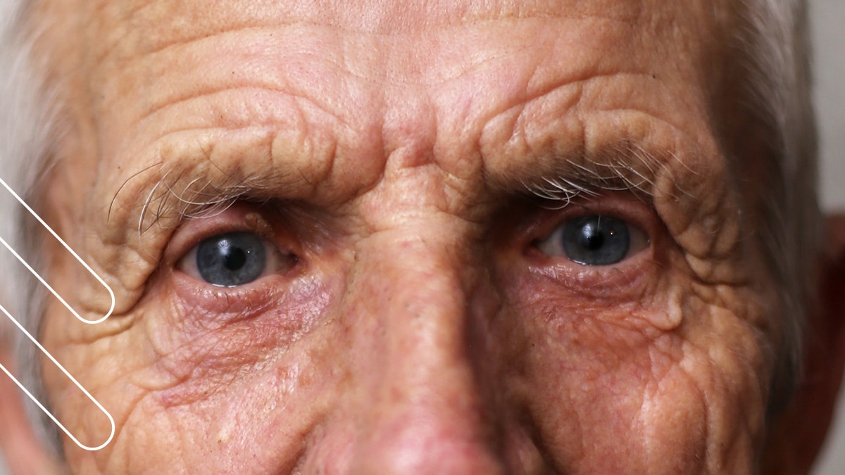 Ectropión - ICQO | Instituto Clínico Quirúrgico de Oftalmología